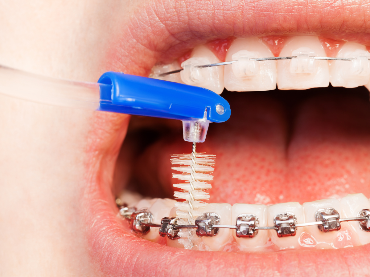 Tips on Taking Care of Your Braces - The Dedicated House